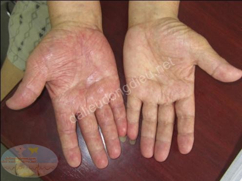 chàm tổ địa ở người già - Da Liễu Việt Nam