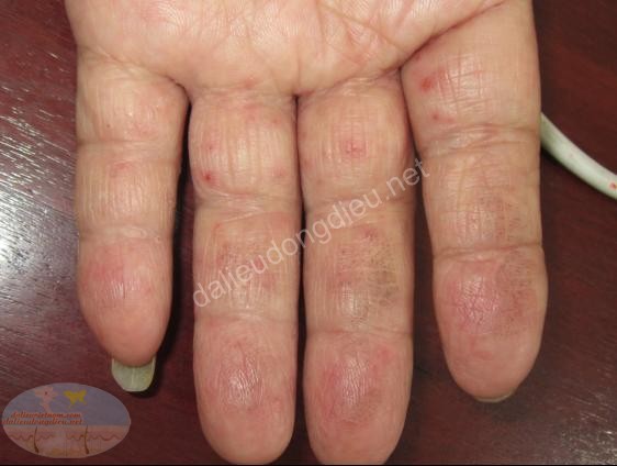 chàm tổ địa ở người già - Da Liễu Việt Nam